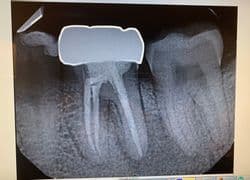 Accuracy Of Digital Implant Impressions